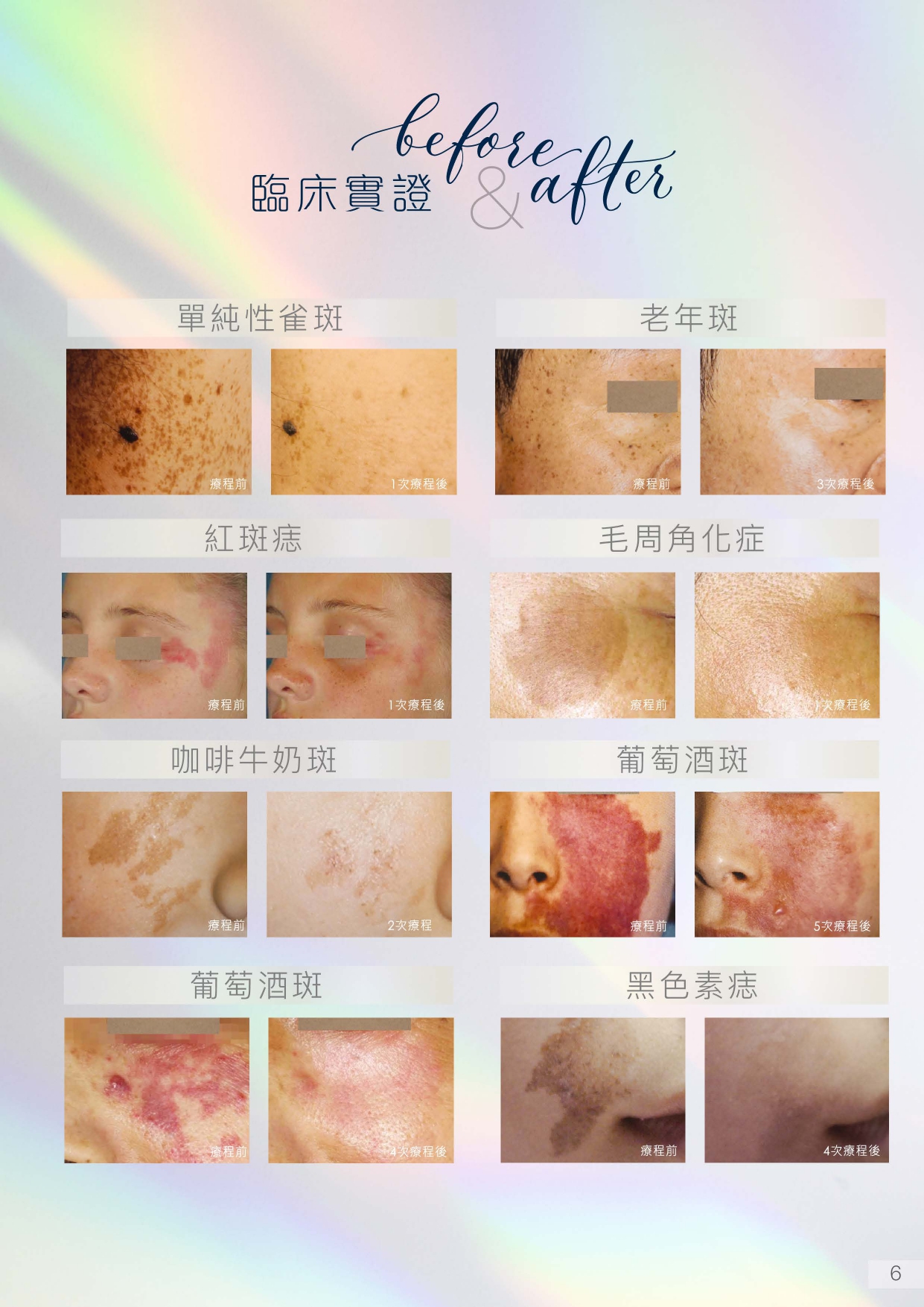 M22 OPT™脈衝光療程 | 光子嫩膚效果 | 限時優惠$680 - AMOUR